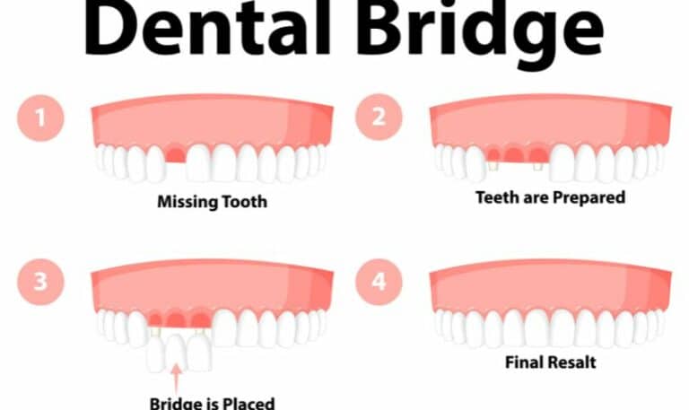 Getting Your Smile Back: How Dental Bridges Can Help